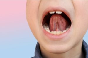 Frenulo linguale corto: cos'è e come intervenire? - Dentista bambini ...